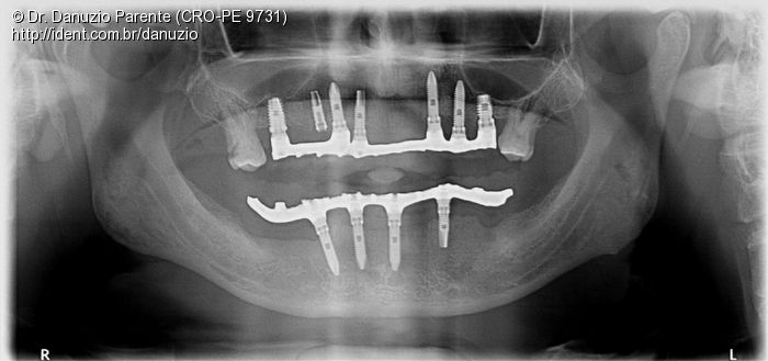 Protocolo Superior e Inferior em Carga Imediata., Caso clínico | iDent