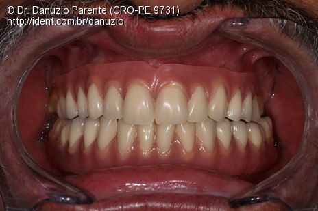 Protocolo Superior e Inferior em Carga Imediata., Caso clínico | iDent