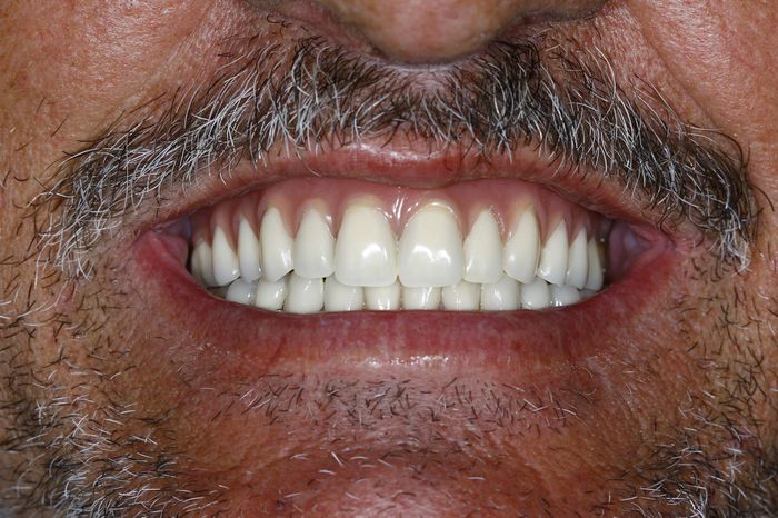 Protocolo Superior e Inferior em Carga Imediata., Caso clínico | iDent