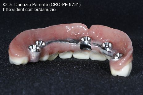 Planejamento Protetico e Cirurgico para Protocolos Superior e Inferior ...