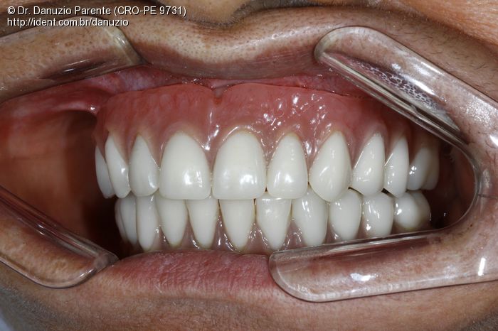 Planejamento Protetico e Cirurgico para Protocolos Superior e Inferior ...