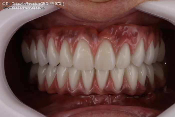 Protocolo Inferior em Carga Imediata + 1 Implante Superior e Nova ...