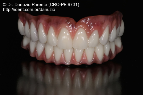 Protocolo Inferior em Carga Imediata + 1 Implante Superior e Nova ...