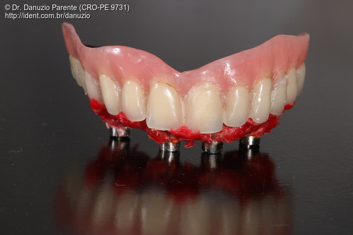 Protocolo Inferior em Carga Imediata + 1 Implante Superior e Nova ...