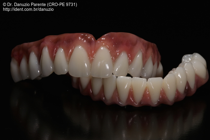 Protocolo Inferior em Carga Imediata + 1 Implante Superior e Nova ...