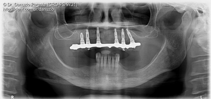 Protocolo Inferior em Carga Imediata + 1 Implante Superior e Nova ...