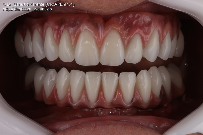 Protocolo Inferior em Carga Imediata + 1 Implante Superior e Nova ...