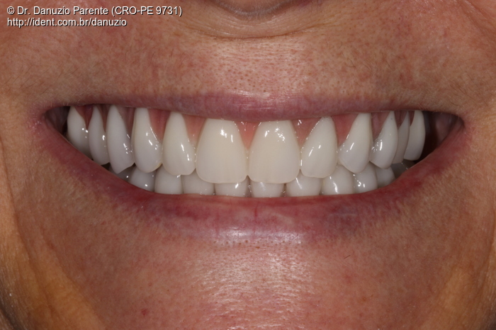 Protocolo Inferior em Carga Imediata + 1 Implante Superior e Nova ...