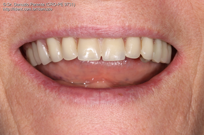 Protocolo Inferior em Carga Imediata + 1 Implante Superior e Nova ...