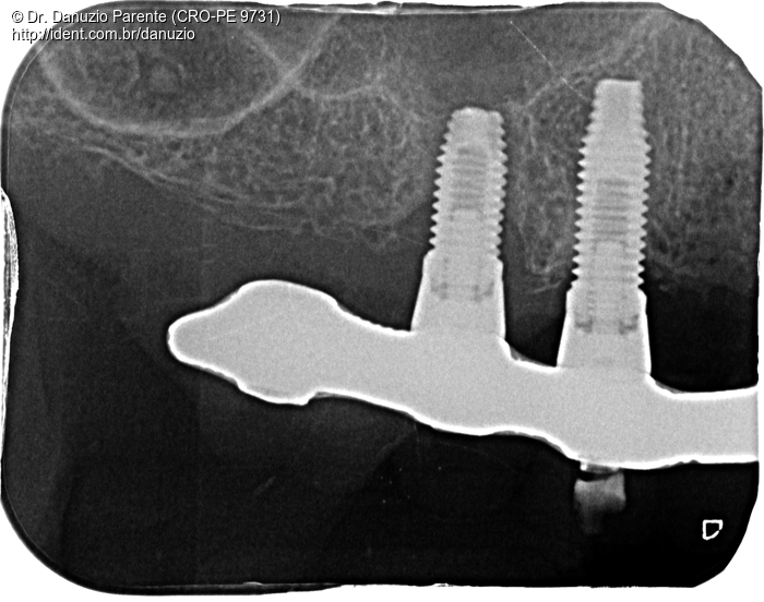 Protocolo Inferior em Carga Imediata + 1 Implante Superior e Nova ...