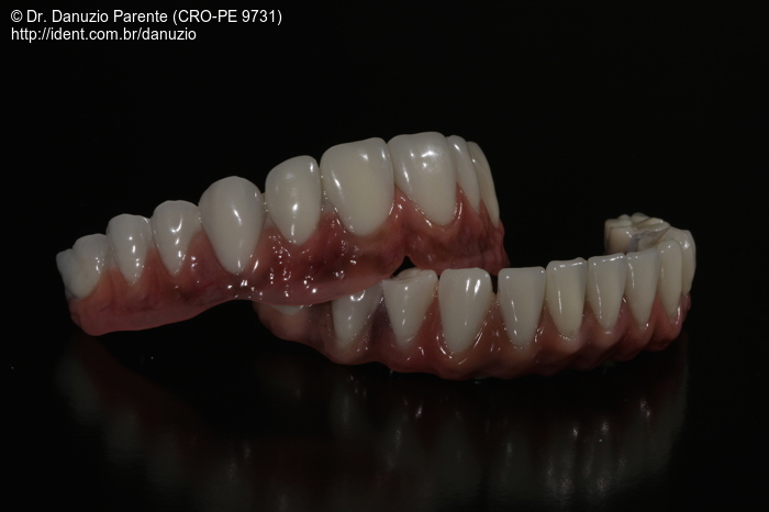 Protocolo Superior e Inferior (50 Dias), Caso clínico | iDent