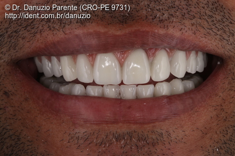 Protocolo Superior e Inferior (50 Dias), Caso clínico | iDent