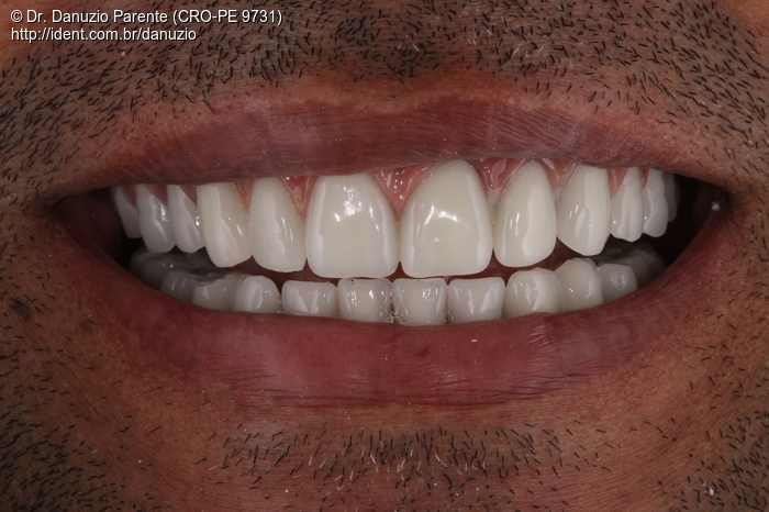 Protocolo Superior e Inferior (50 Dias), Caso clínico | iDent