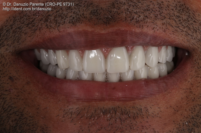 Protocolo Superior e Inferior (50 Dias), Caso clínico | iDent