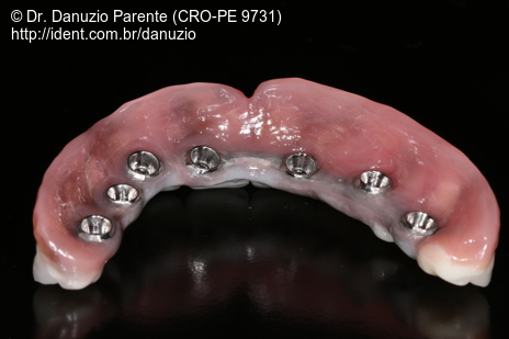 Protocolo Superior e Inferior (50 Dias), Caso clínico | iDent