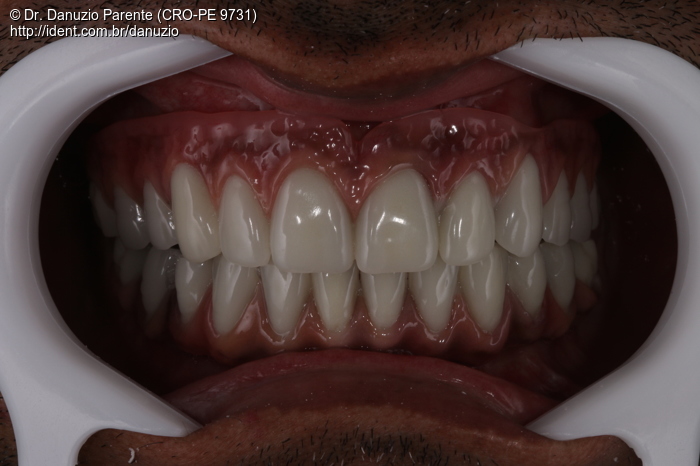 Protocolo Superior e Inferior (50 Dias), Caso clínico | iDent