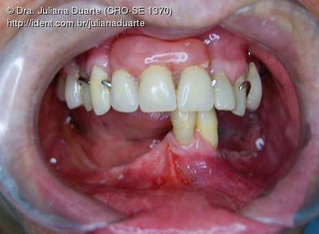 Protocolo Inferior, com Exodontias e Carga Imediata, Caso clínico | iDent