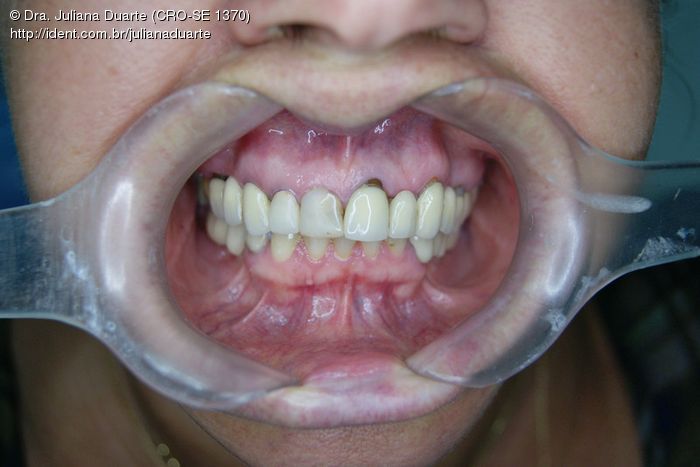 Prótese Fixa de 13 Elementos, Caso clínico | iDent