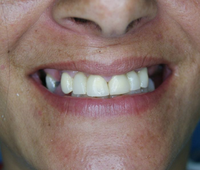 Prótese Fixa 6 Elementos, Devolvendo o Sorriso, Caso clínico | iDent