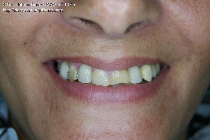 Prótese Fixa 6 Elementos, Devolvendo o Sorriso, Caso clínico | iDent