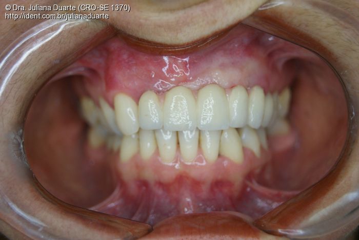 Protese Parcial Anterior com Implantes, Caso clínico | iDent