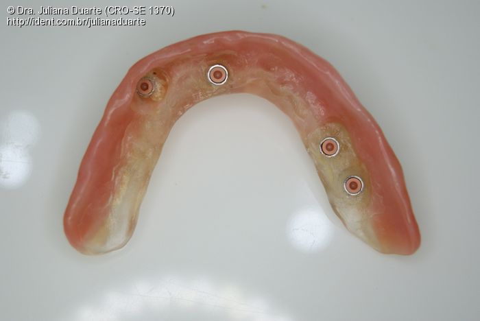 Overdenture com Attachment Bola + O´Ring, Artigo | iDent