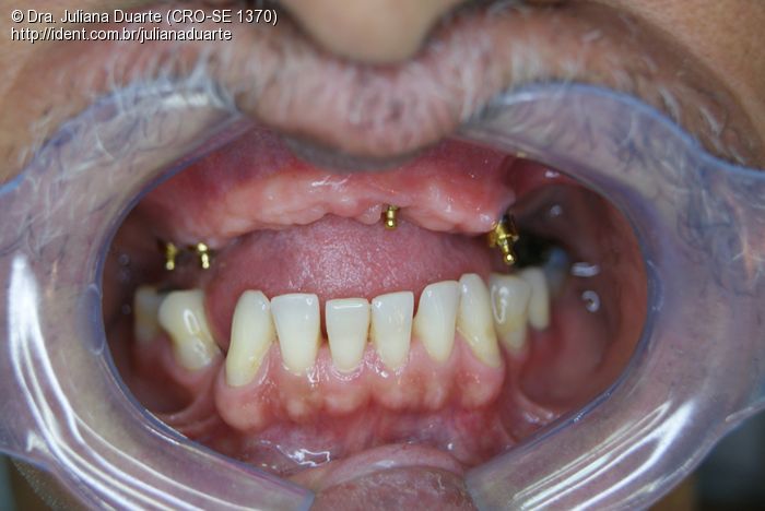 Overdenture com Attachment Bola + O´Ring, Artigo | iDent