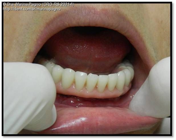 Protocolo Inferior Carga Imediata, Caso clínico | iDent