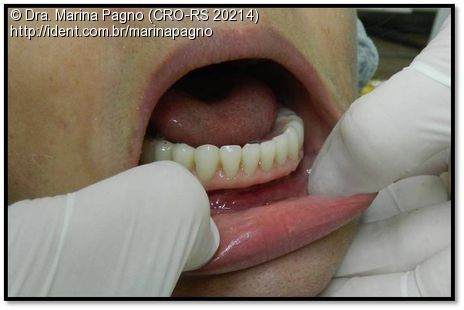 Protocolo Inferior Carga Imediata, Caso clínico | iDent