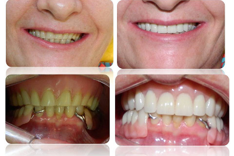 Protocolo Inferior, Cirúrgico e Prótese Final, Caso clínico | iDent