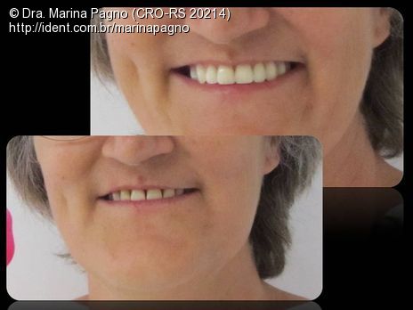 Prótese Total, Caso clínico | iDent