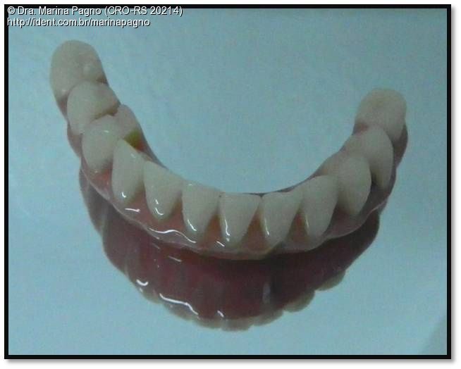 Protocolo Inferior, Cirúrgico e Prótese Final, Caso clínico | iDent