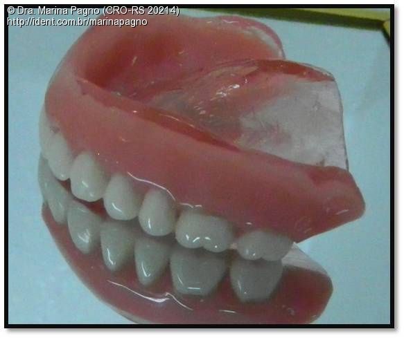 Protocolo Inferior, Cirúrgico e Prótese Final, Caso clínico | iDent