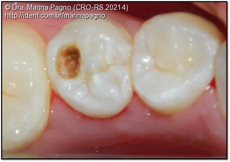 Cárie Oculta, Proteção do Complexo Dentina-Polpa, Resina Composta ...