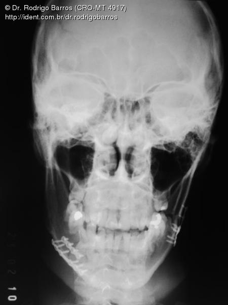 (Trauma) Fratura Bilateral de Mandibula, Caso clínico | iDent