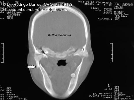(Trauma) Fratura de Côndilo Mandibular + Sínfise Mentoniana + Arco ...