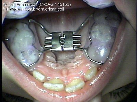Ortodontia, Caso clínico | iDent