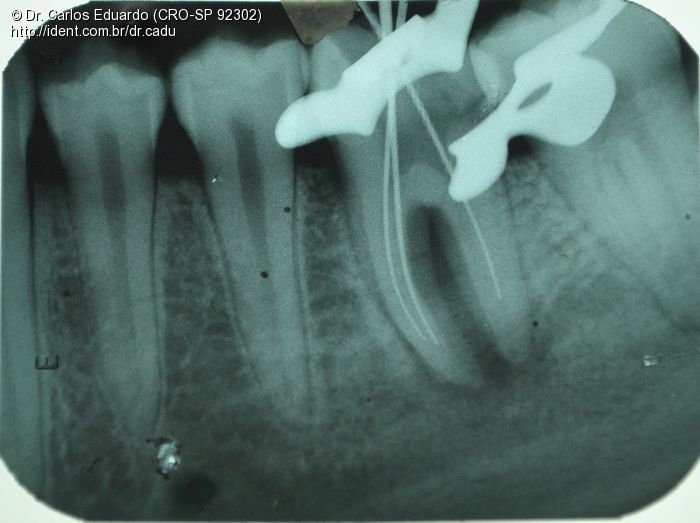 Tratamento Endodontico Dente 46 - Necropulpectomia Ii, Caso clínico | iDent