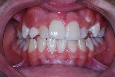 Paciente com Atresia Maxilar Severa - Padrão Vertical, Caso clínico | iDent