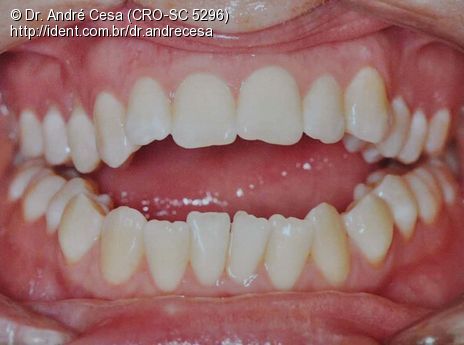 Mordida Aberta Esquelética - em Tratamento, Caso clínico | iDent