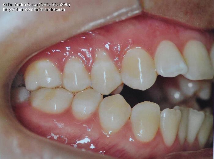 Mordida Aberta Esquelética - em Tratamento, Caso clínico | iDent