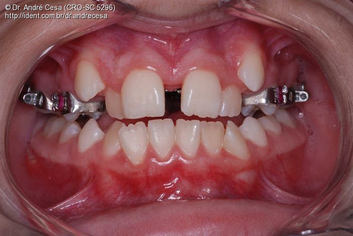 Paciente com Atresia Maxilar Severa - Padrão Vertical, Caso clínico | iDent