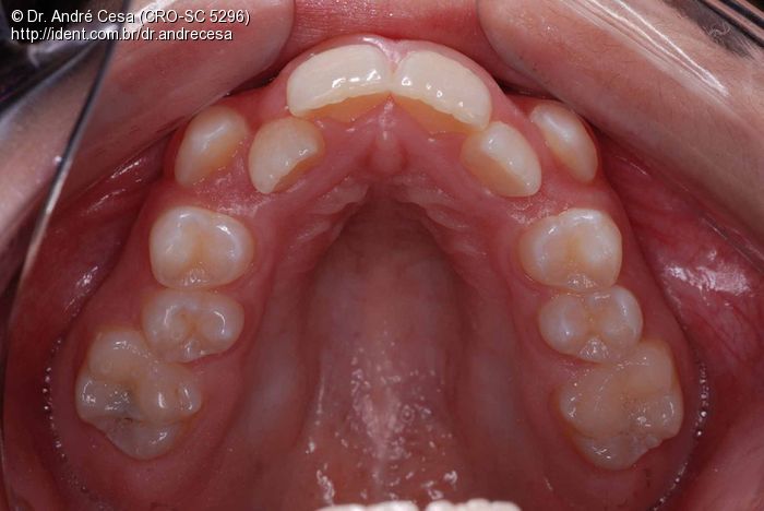 Paciente com Atresia Maxilar Severa - Padrão Vertical, Caso clínico | iDent