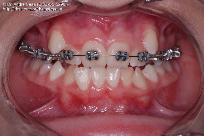 Paciente com Atresia Maxilar Severa - Padrão Vertical, Caso clínico | iDent