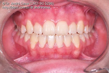 Paciente com Atresia Maxilar Severa - Padrão Vertical, Caso clínico | iDent