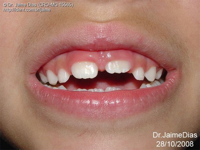 Ulectomia por Eletrocirurgia, Caso clínico | iDent