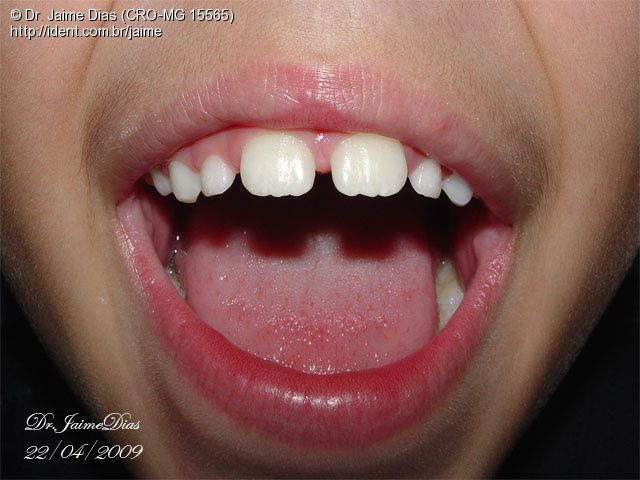 Ulectomia por Eletrocirurgia, Caso clínico | iDent