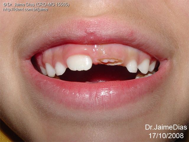 Ulectomia por Eletrocirurgia, Caso clínico | iDent