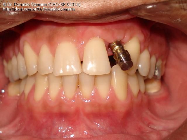 Implante em Incisivo Lateral Superior e Regeneraçào Óssea Guiada., Caso ...