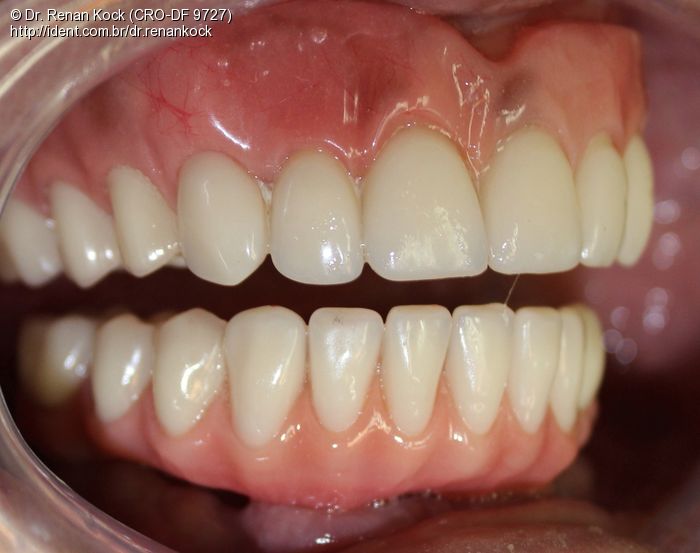 Protocolo Inferior Imediato, Caso clínico | iDent